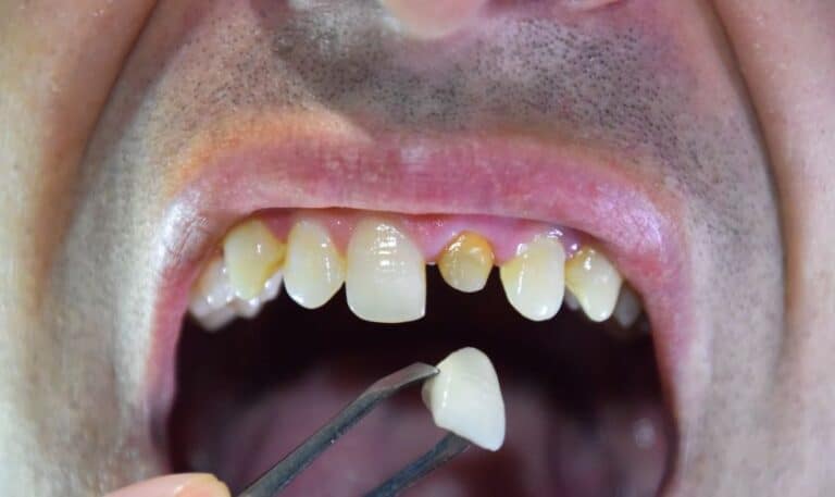 Dental Crown vs Natural Tooth: Which Is Stronger?